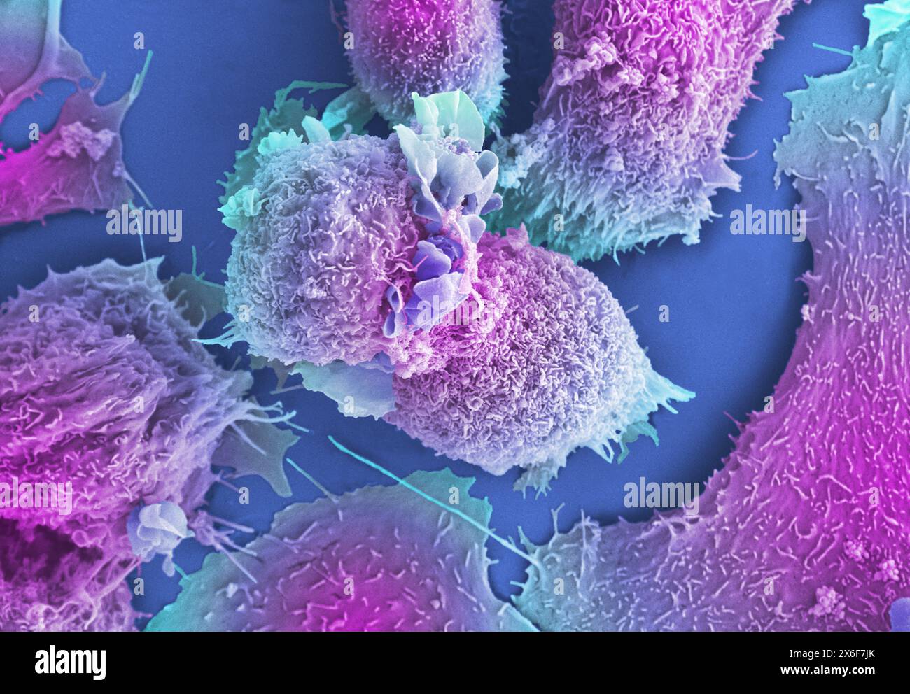 Lung cancer cells, coloured scanning electron micrograph (SEM). Lung ...