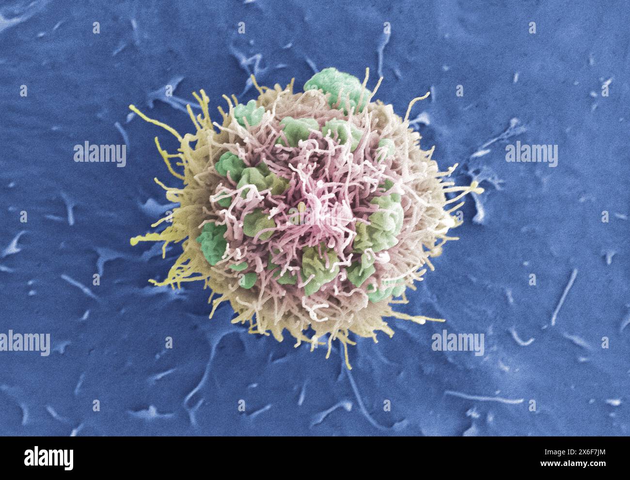Cervical cancer cell, coloured scanning electron micrograph (SEM). The ...
