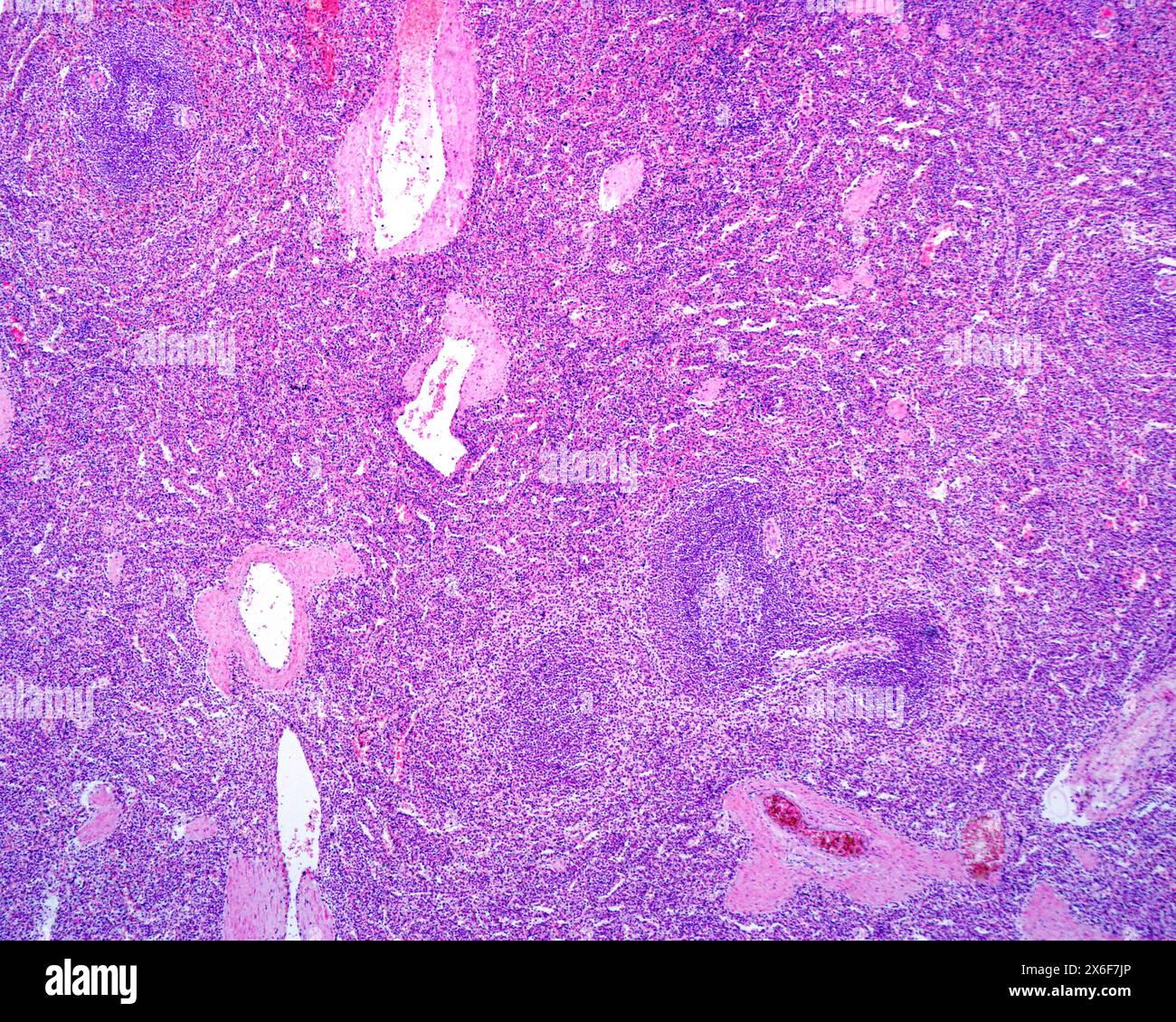 Light micrograph of the spleen in a case of Banti syndrome. Banti ...