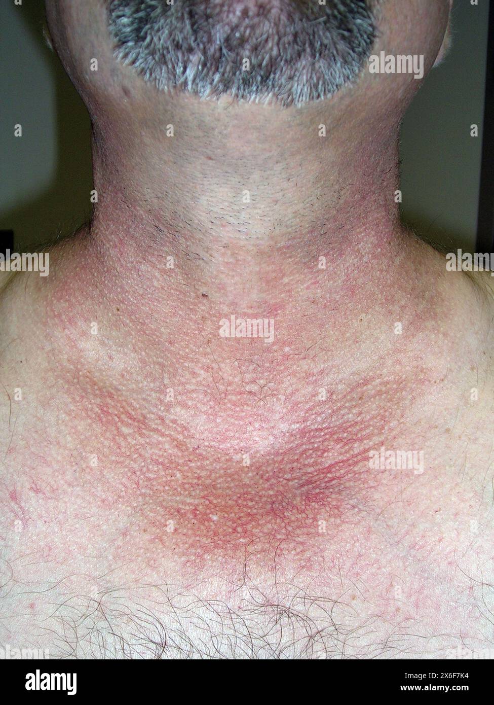 Neck of a male patient with Poikiloderma of Civatte. This chronic skin ...
