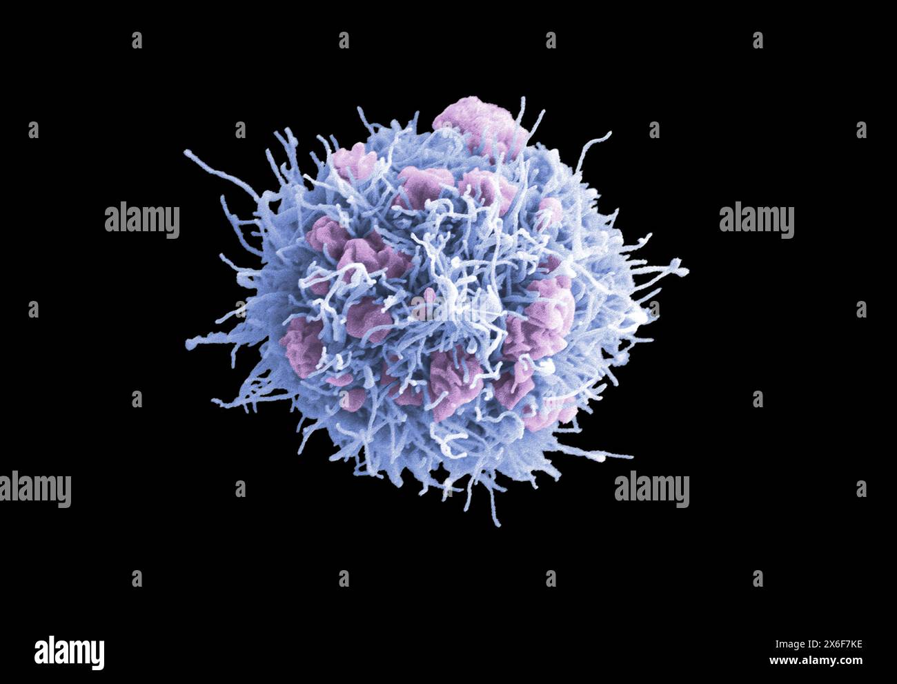 Cervical cancer cell, coloured scanning electron micrograph (SEM). The ...