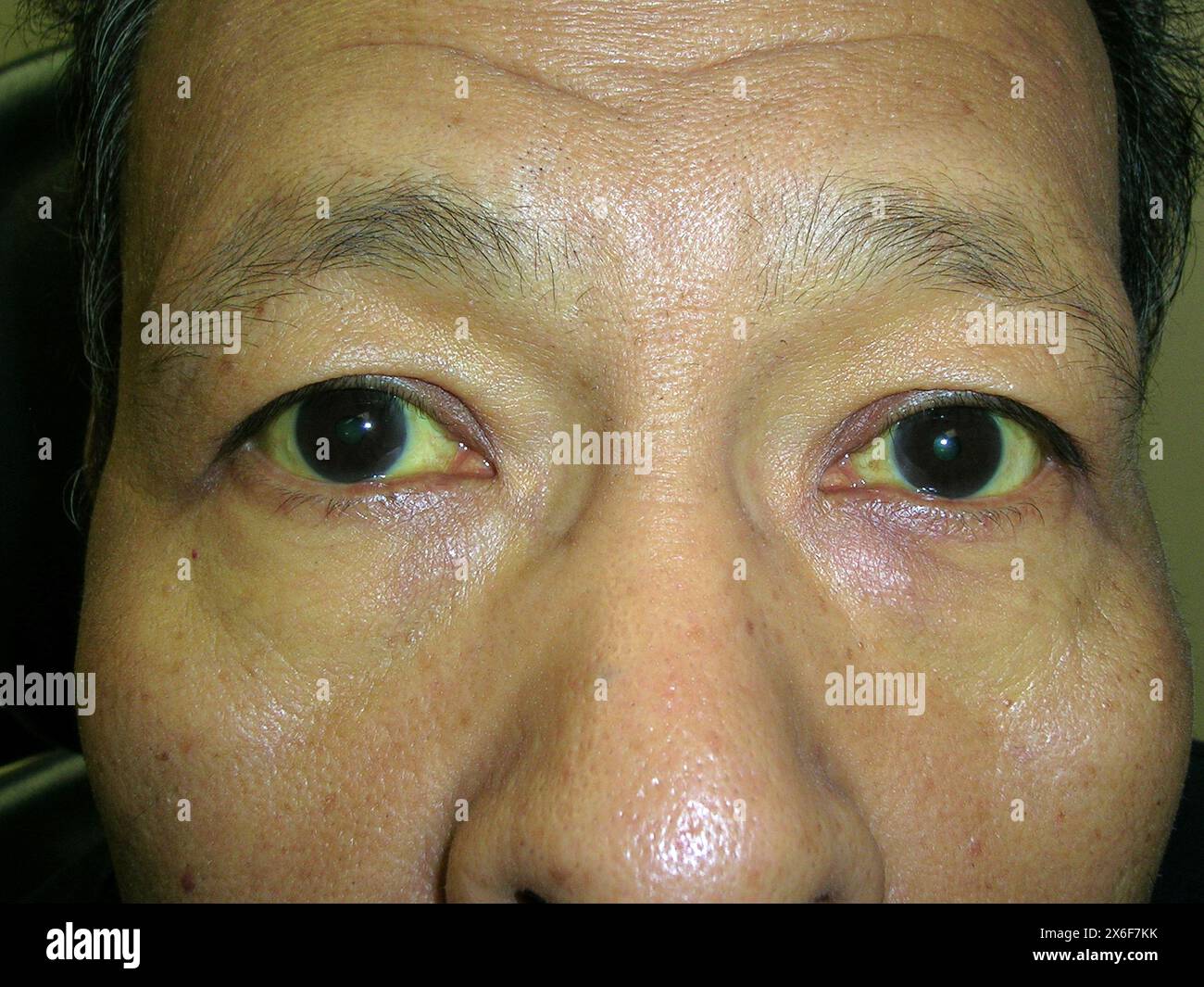 Jaundice in a male patient. Jaundice is a condition in which the skin ...