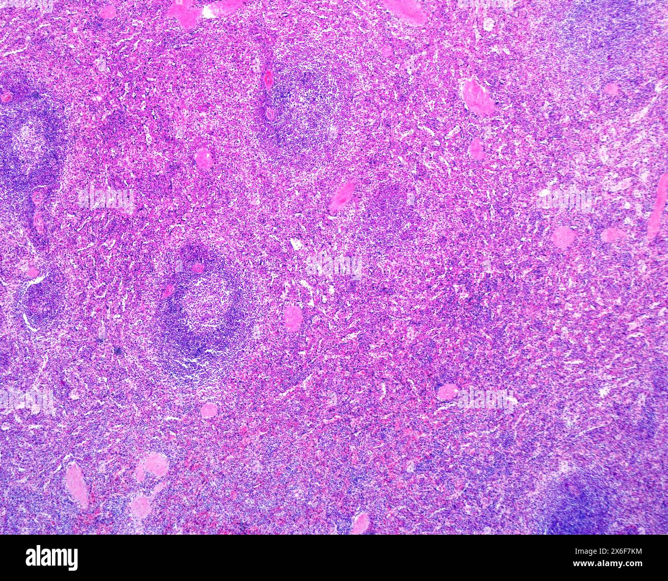 Light micrograph of the spleen in a case of Banti syndrome. Banti ...