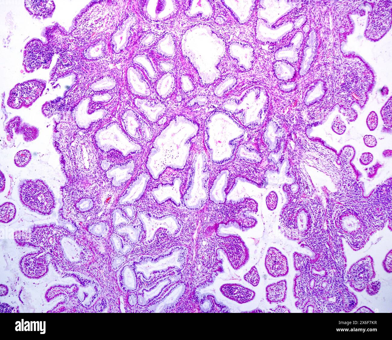 Light micrograph of a human endocervical polyp showing a proliferation ...