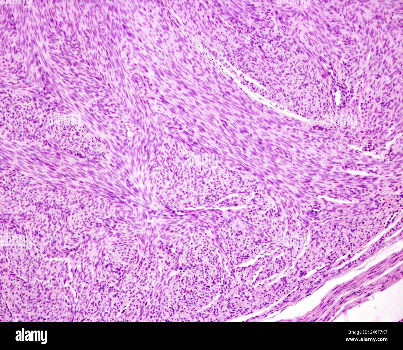 Light micrograph of a uterine fibroid, or leiomyoma, a common benign ...