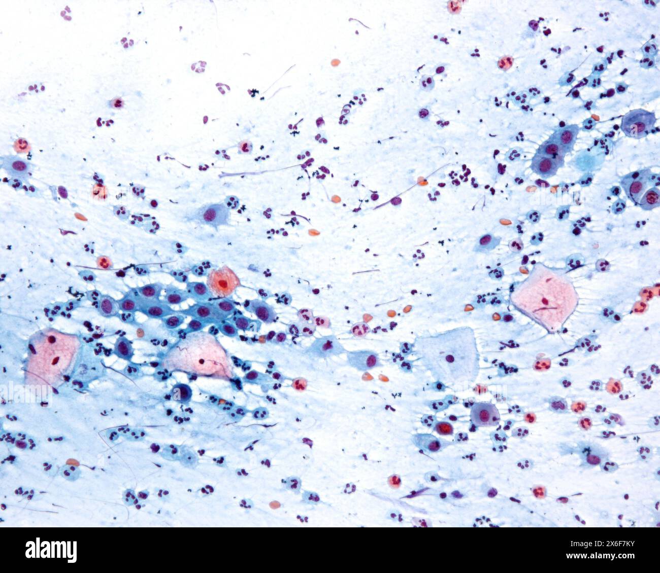 Light micrograph of a vaginal smear stained with the Papanicolaou ...