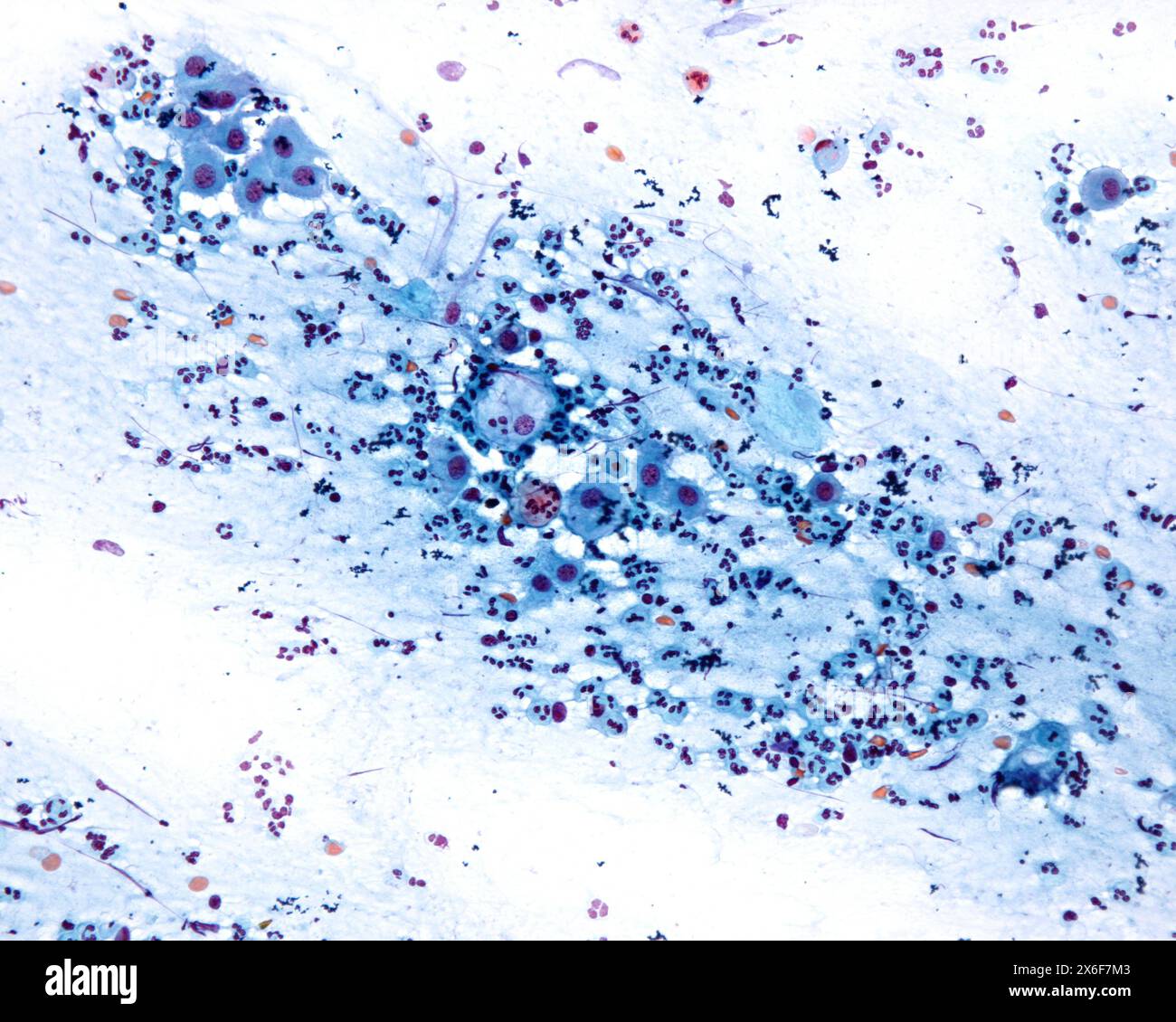 Light micrograph of a vaginal smear stained with the Papanicolaou ...
