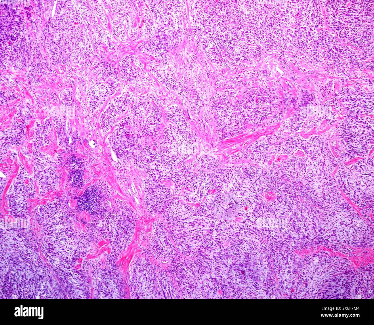 Pleomorphic adenoma in submaxillary gland, light micrograph ...