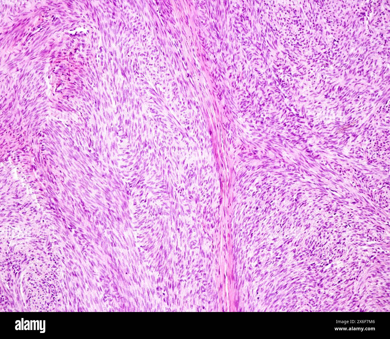 Light micrograph of a uterine fibroid, or leiomyoma, a common benign ...