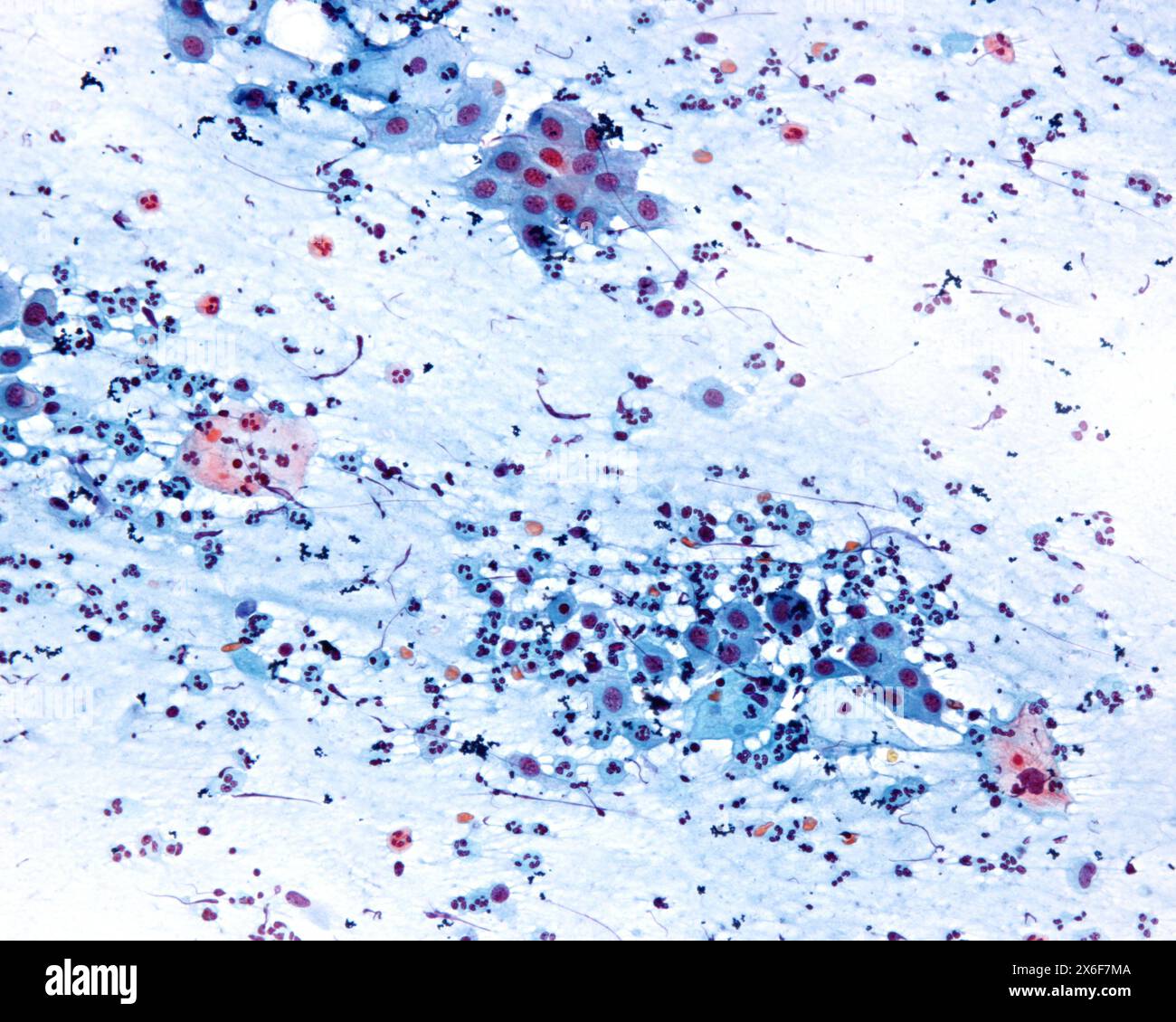 Light micrograph of a vaginal smear stained with the Papanicolaou ...