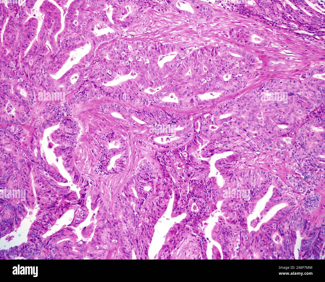 Ovarian cancer, light micrograph. Serous ovarian cancer is the most ...