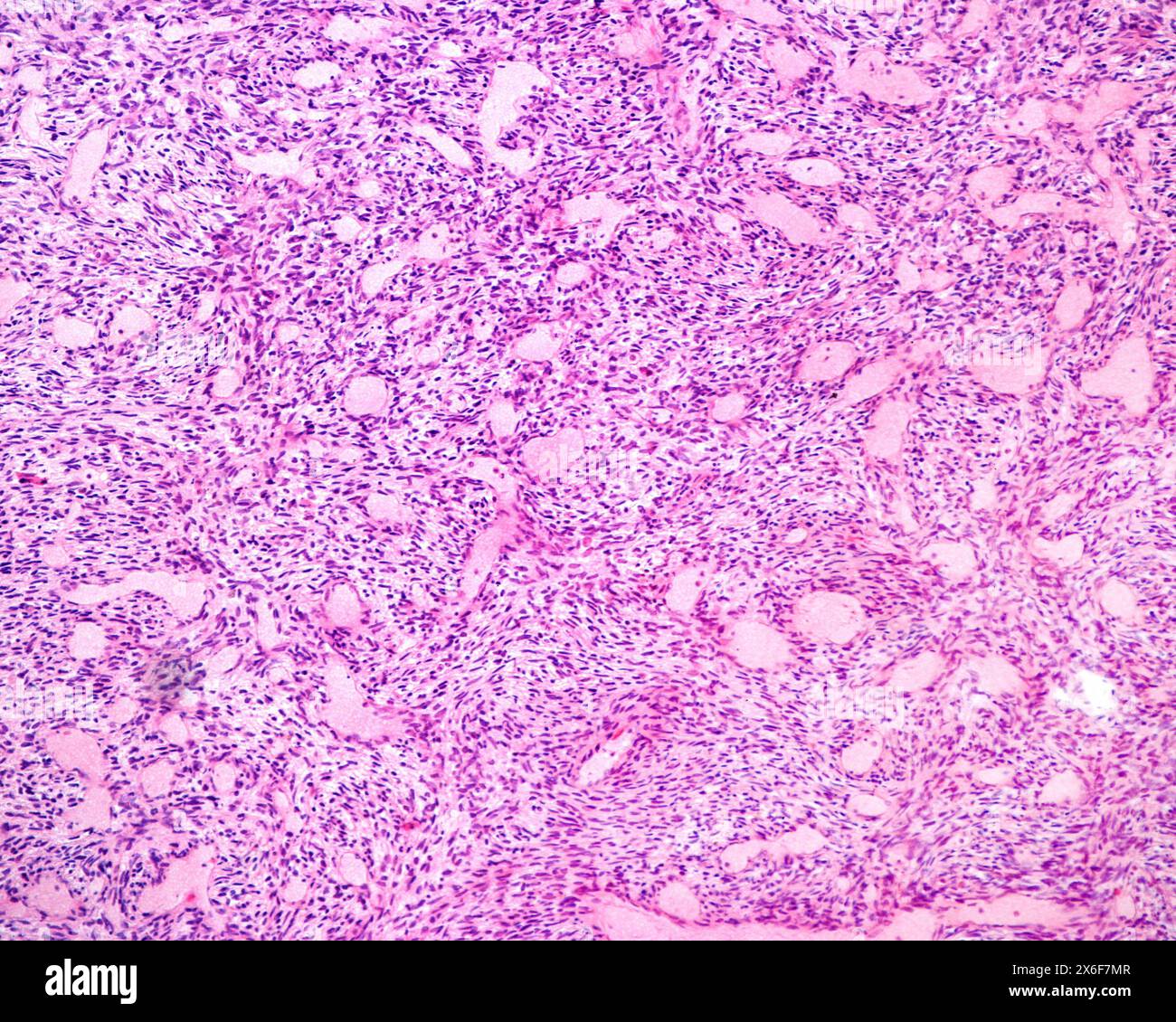 Light micrograph of a fibrosarcoma, a malignant (cancerous) mesenchymal ...