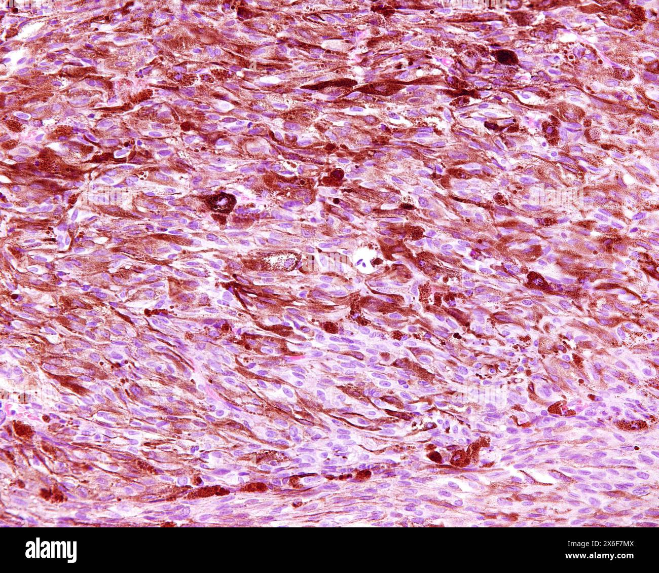 Light micrograph of a melanoma, the most deadly of all skin cancers ...