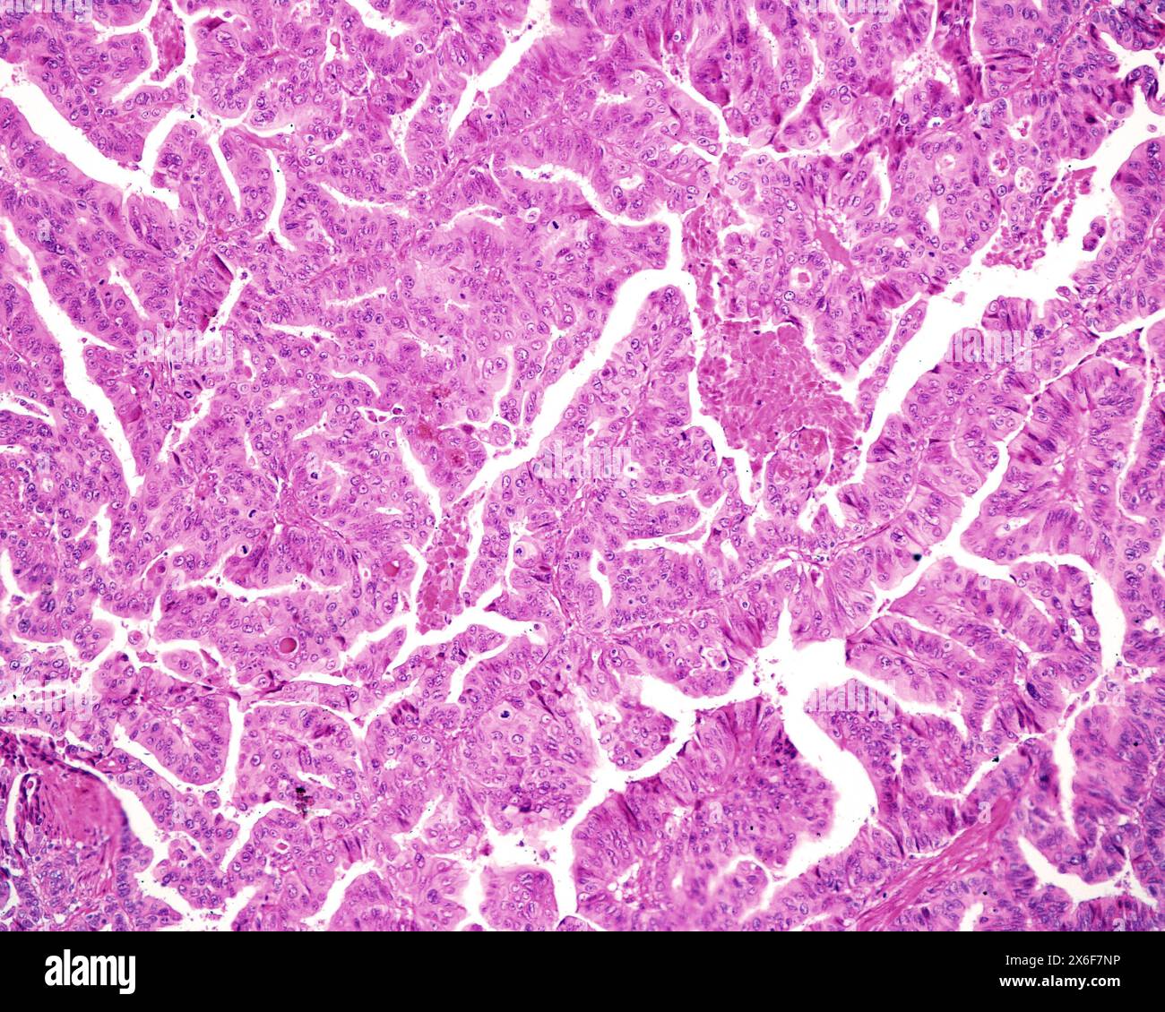 Ovarian cancer, light micrograph. Serous ovarian cancer is the most ...