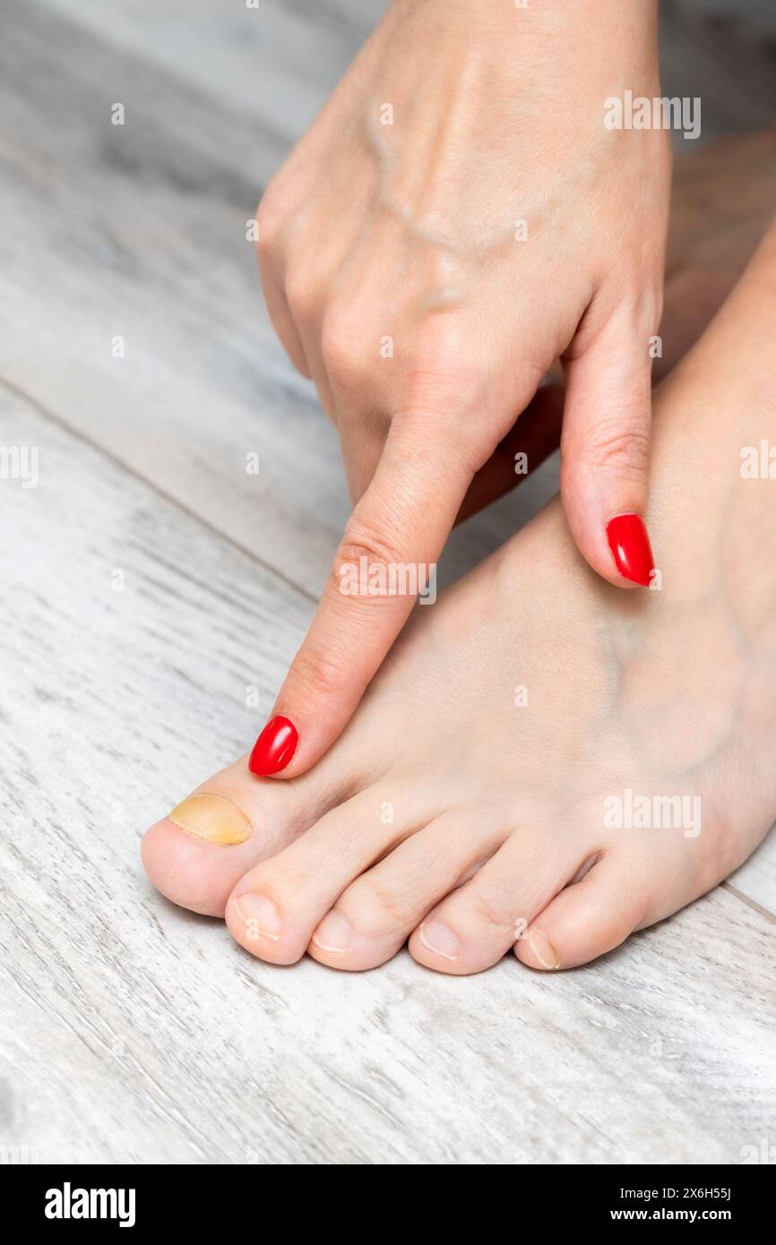 woman examining the horn on her big toe. nail fungus. toenail disease ...