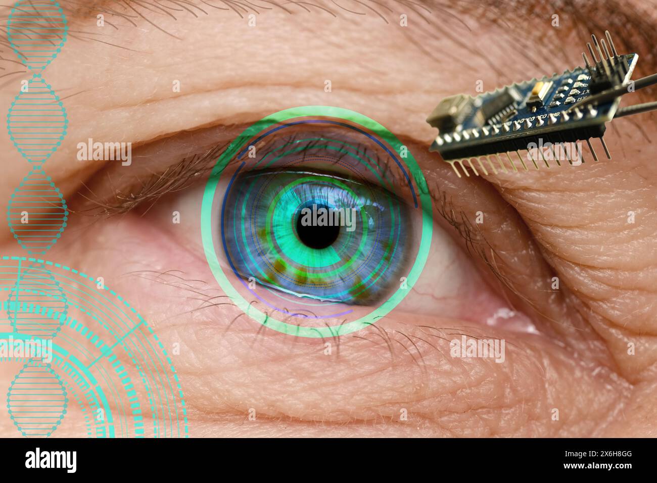 Installing electronic chip into human bionic, neuroprosthetic eye ...
