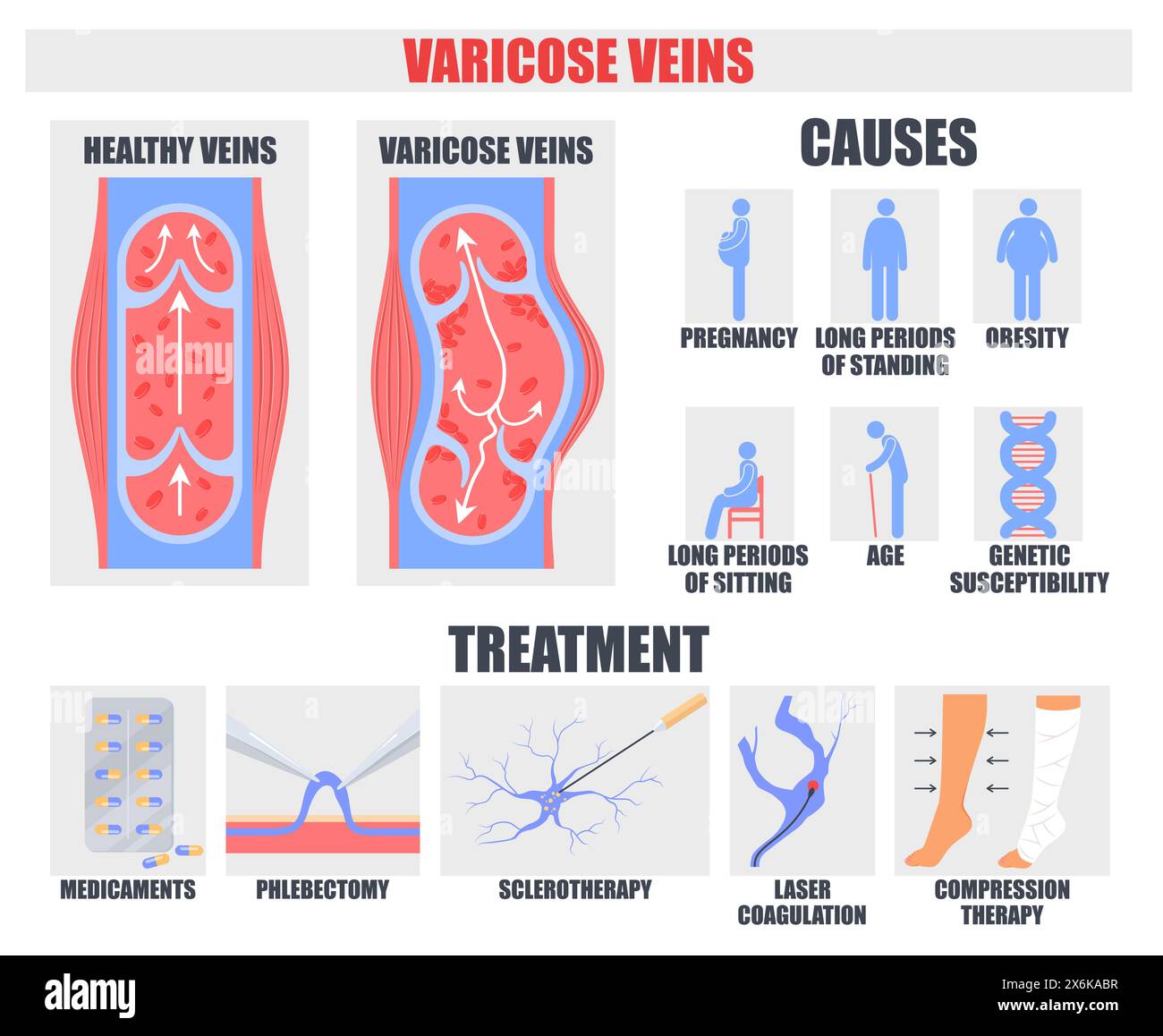 Varicose vein disease symptom Stock Vector Images - Alamy
