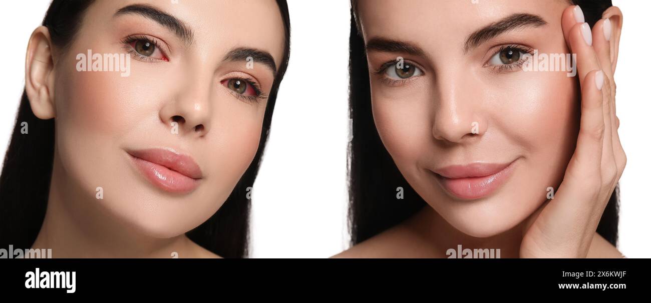 Before and after conjunctivitis treatment. Photos of woman with red and ...