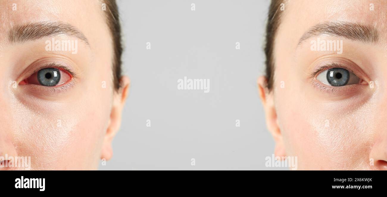 Before and after conjunctivitis treatment. Photos of woman with red and ...