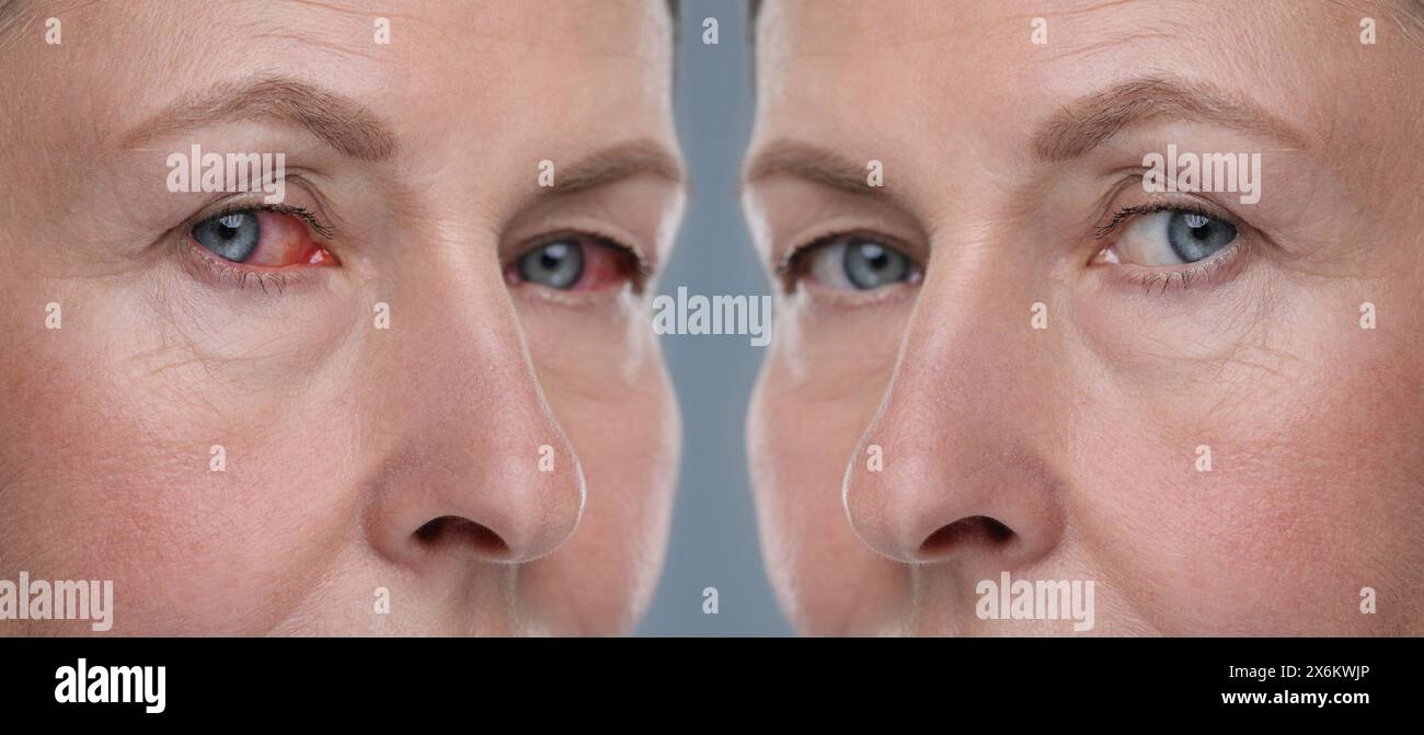 Before and after conjunctivitis treatment. Photos of woman with red and ...
