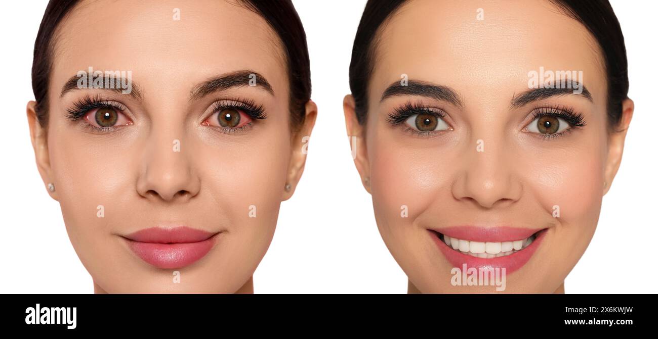 Before and after conjunctivitis treatment. Photos of woman with red and ...