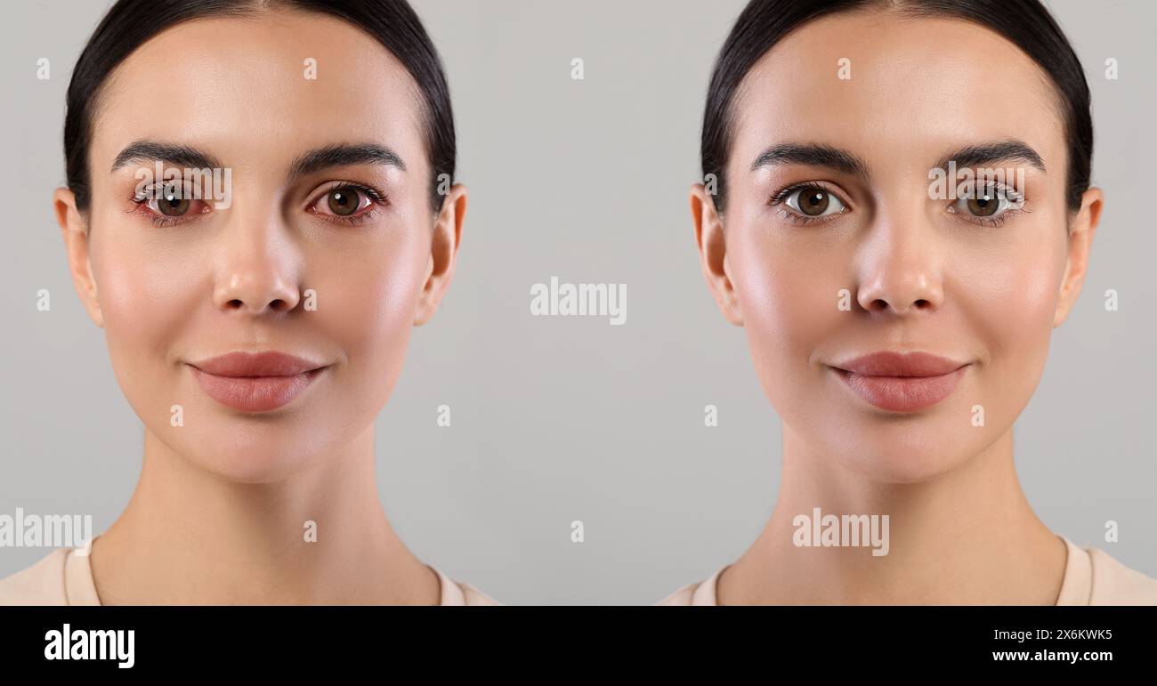 Before and after conjunctivitis treatment. Photos of woman with red and ...