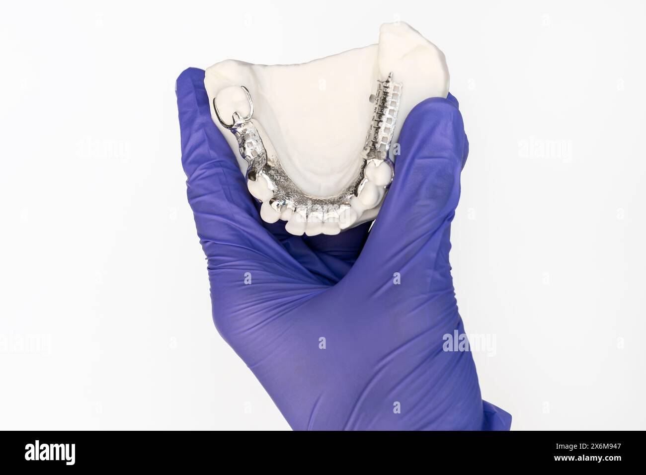 Isolated Metal Frame Lower Partial Denture with Die Stone, Plaster Cast ...