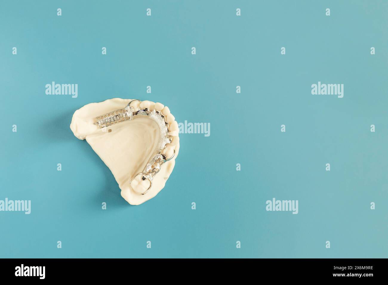 Mockup Metal Frame Lower Partial Denture, Plate On Die Stone, Plaster ...