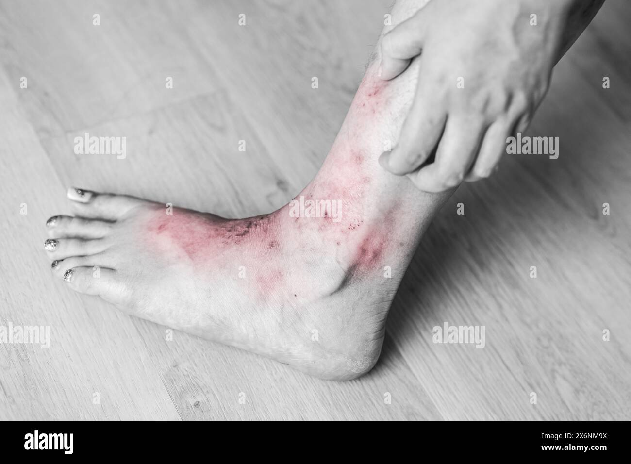 Itchy skin rash hi-res stock photography and images - Alamy