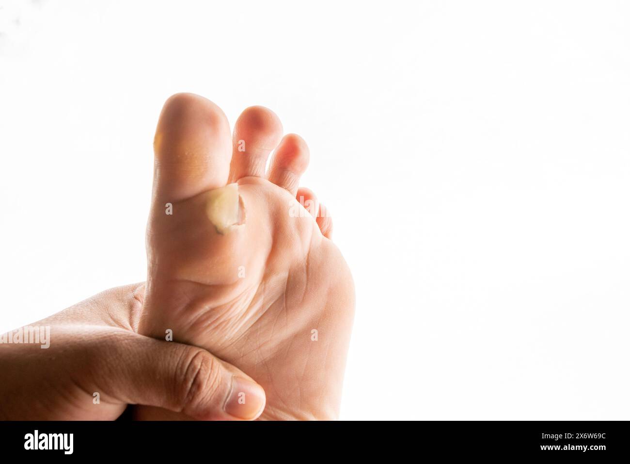 foot with a callus, skin peeling off the bottom of the foot Stock Photo ...