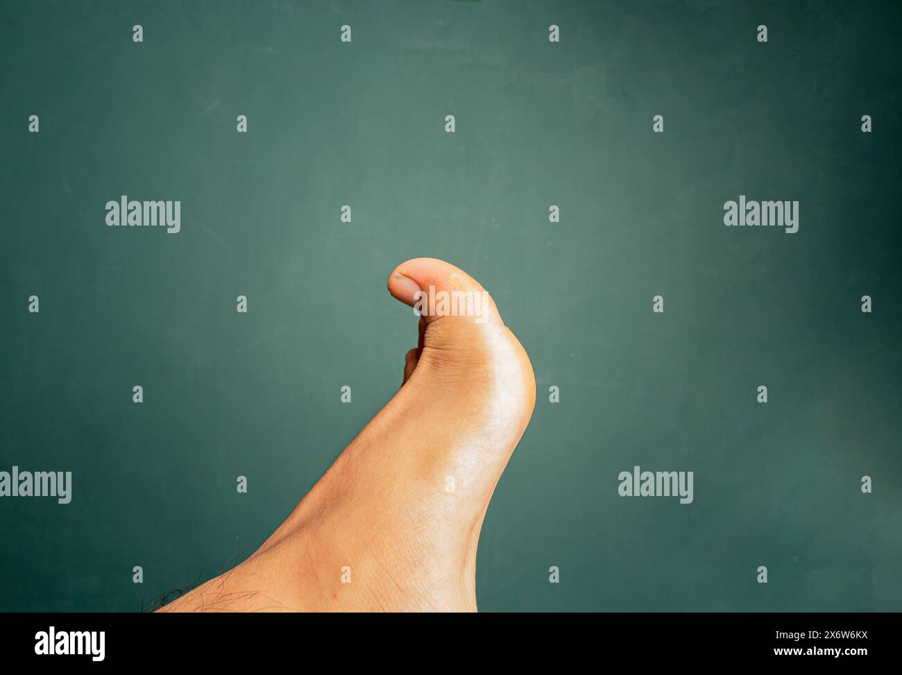 Foot with dry skin on heel and sole. male feet, with rough and cracked ...