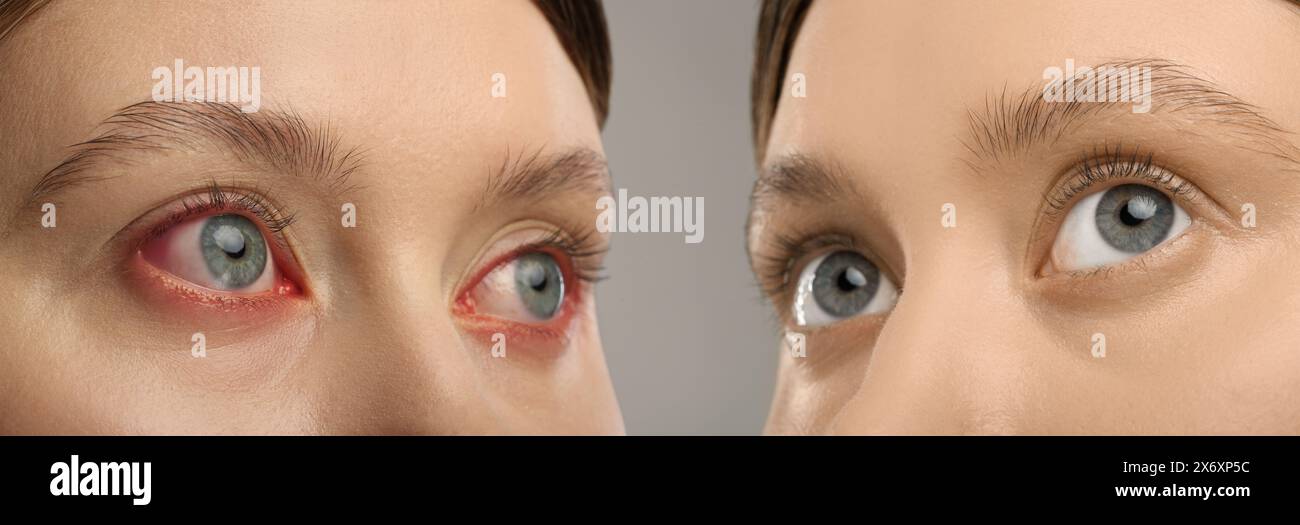 Before and after conjunctivitis treatment. Photos of woman with red and ...