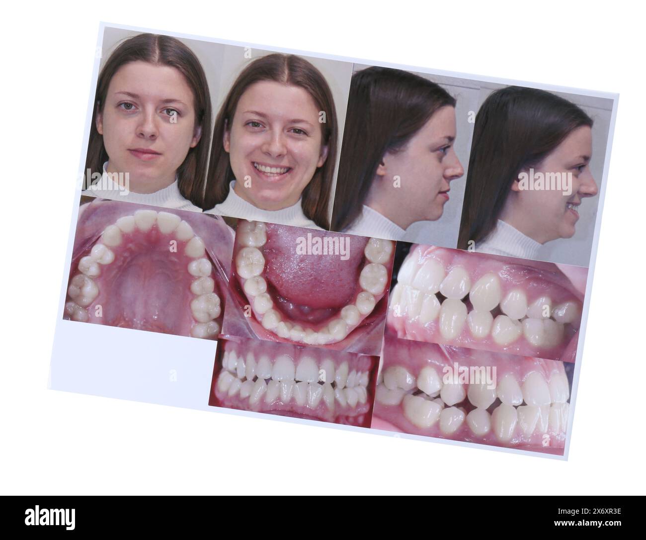 Photos of woman and her teeth from different sides isolated on white ...