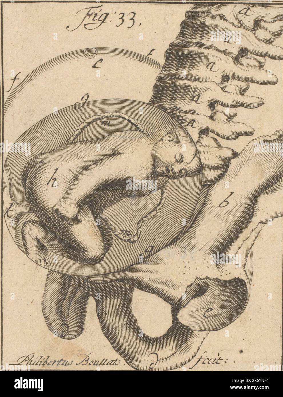 Breech position of a fetus, A book illustration of a fetus in breech ...