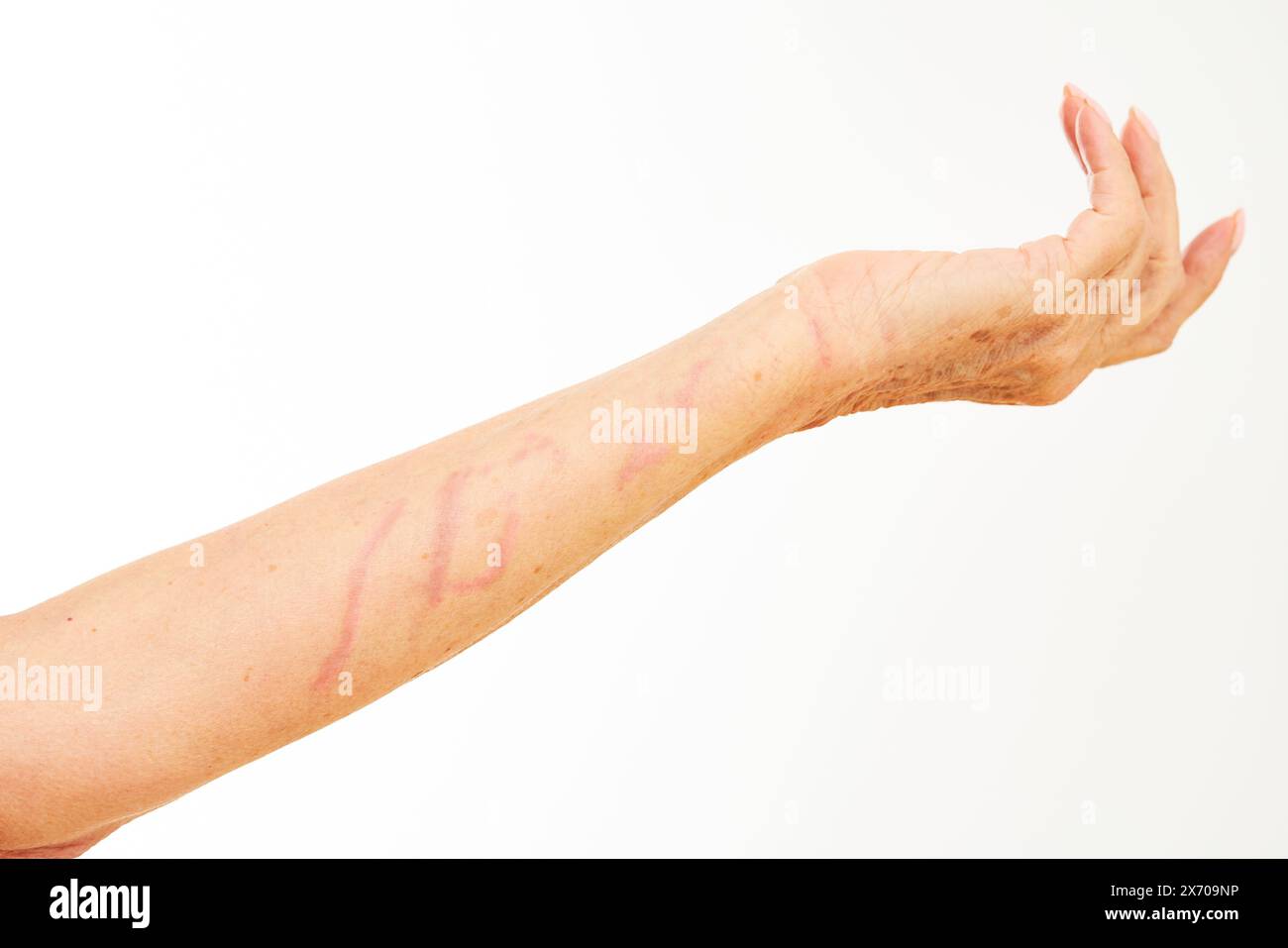 Picture female body skin burned skin burned by jellyfish portuguese man ...