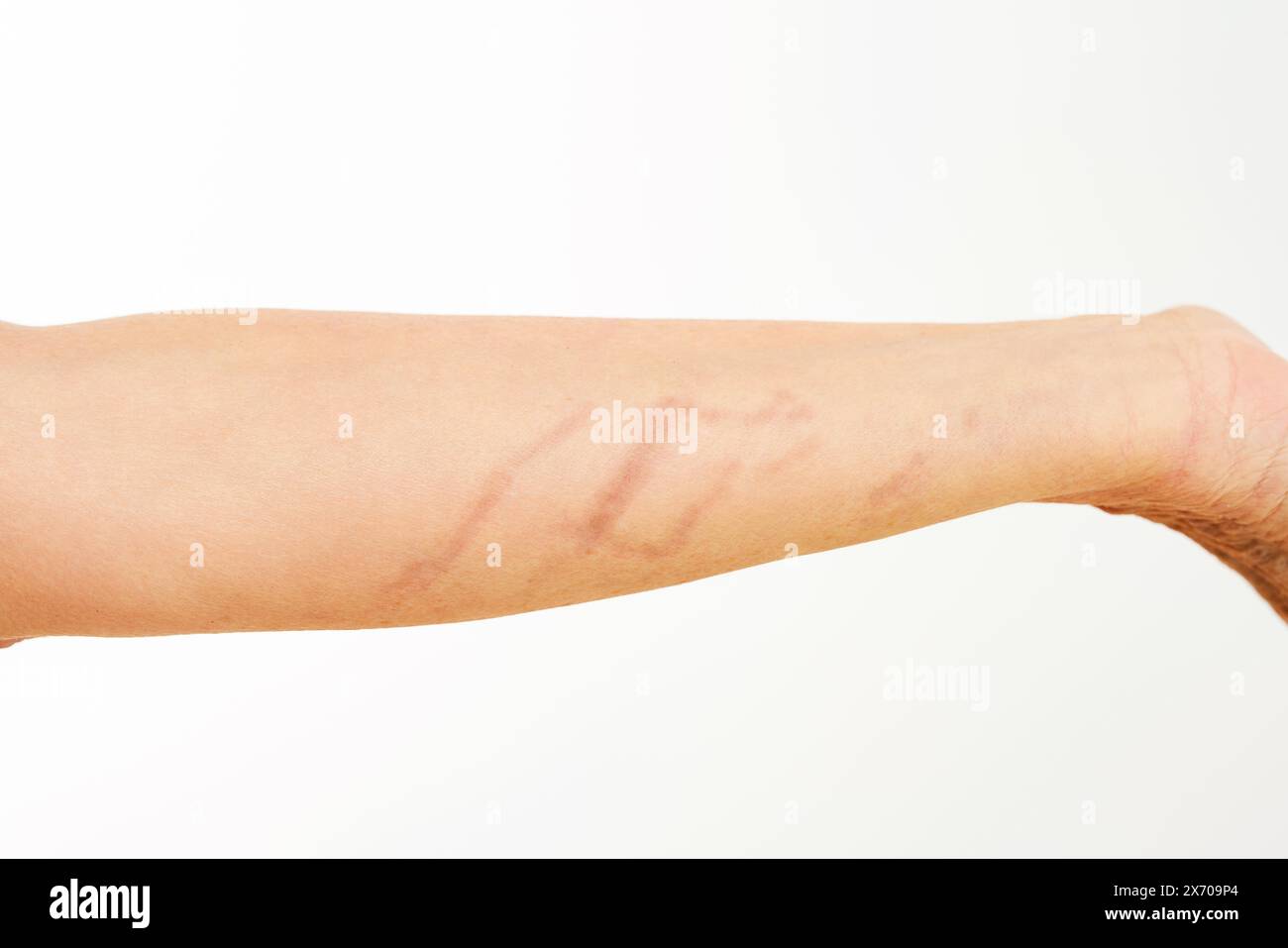 Picture female body skin burned skin burned by jellyfish portuguese man ...