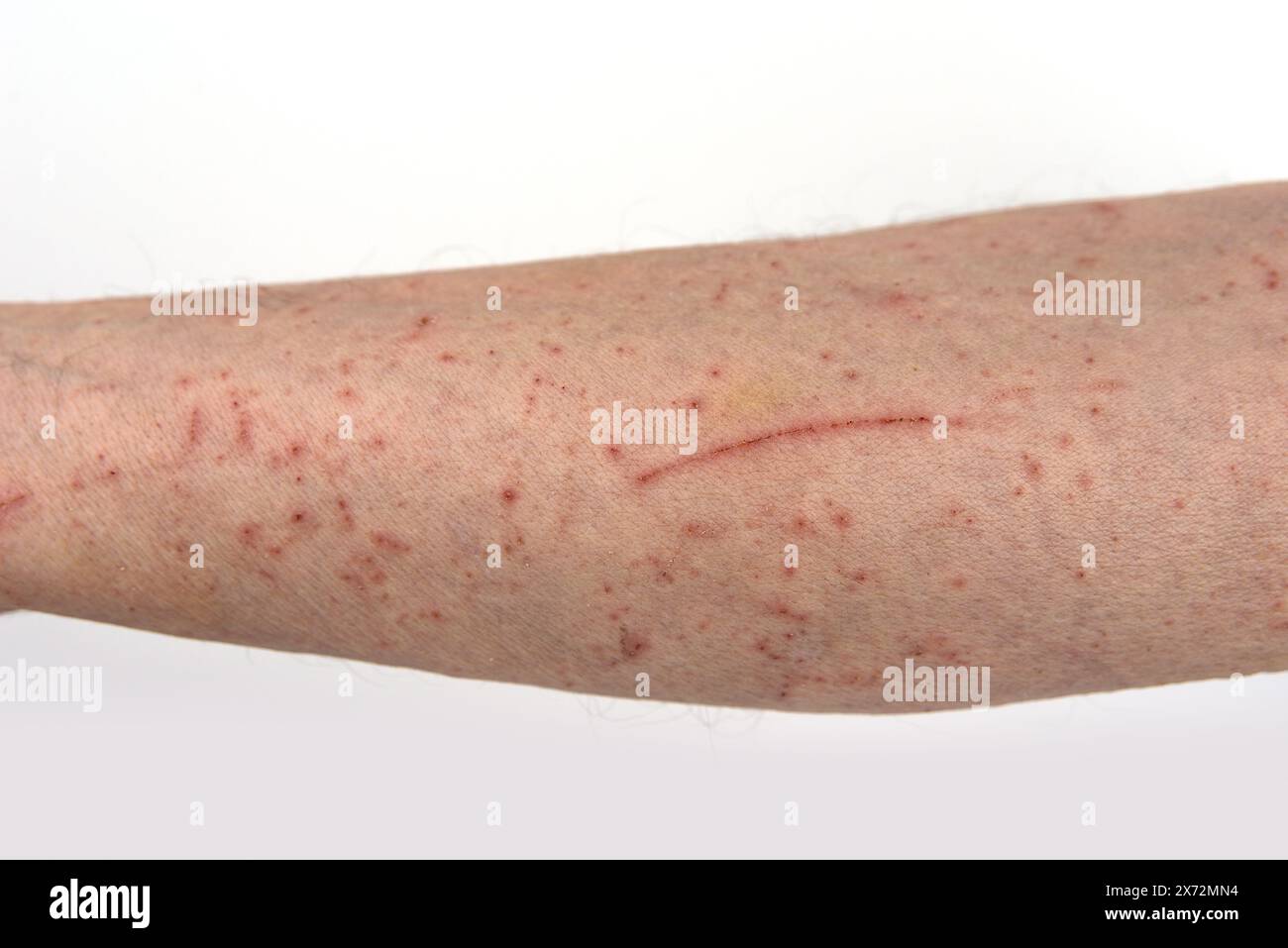 Rush and scratches on the senior man hand Stock Photo - Alamy