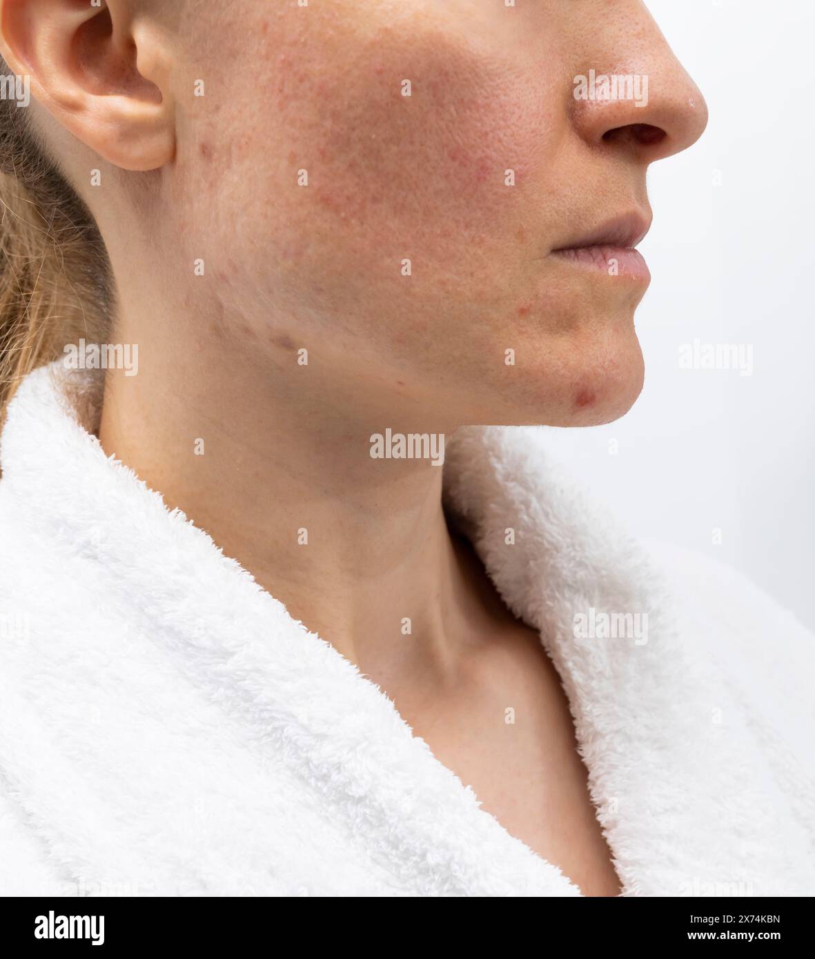 Closeup Face of Woman in her 30s with Acne Problem, Couperosis ...