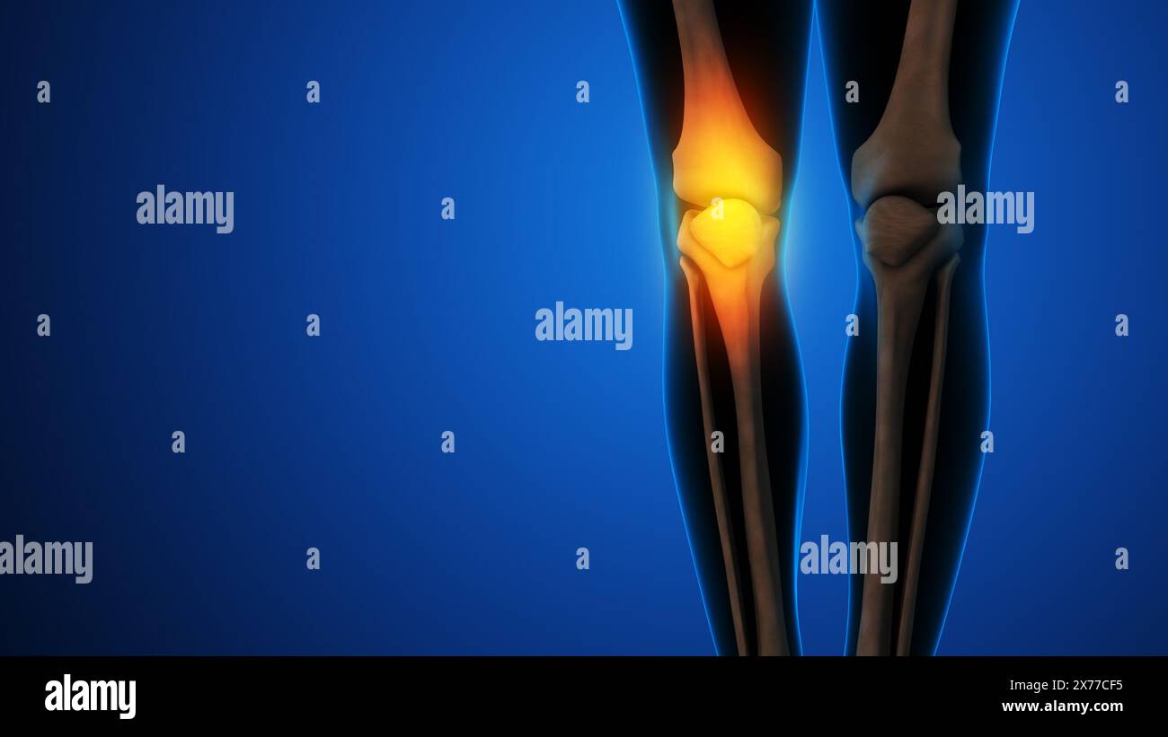 Human knee joint and bones with inflammation Stock Photo - Alamy