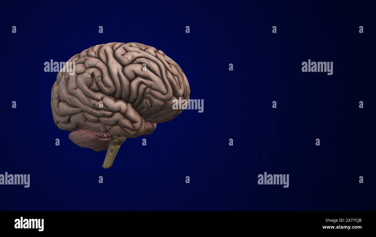 Brain bleed or an intracranial Hemorrhage Stock Photo - Alamy