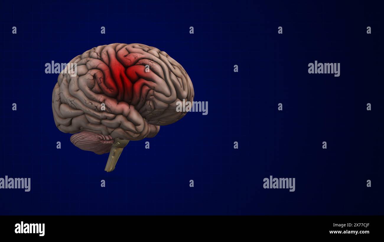 Brain bleed or an intracranial Hemorrhage Stock Photo - Alamy