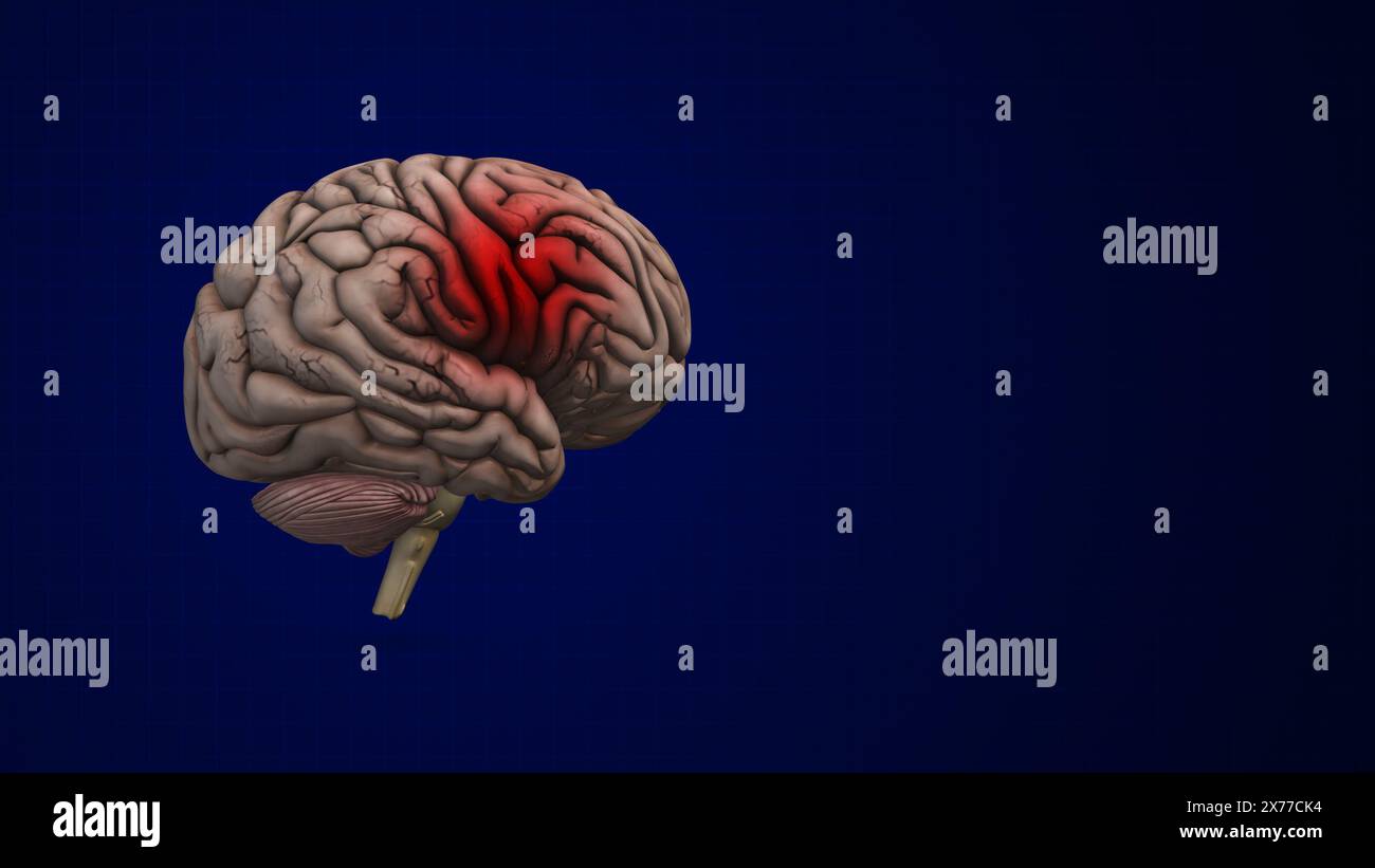 Brain bleed or an intracranial Hemorrhage Stock Photo - Alamy