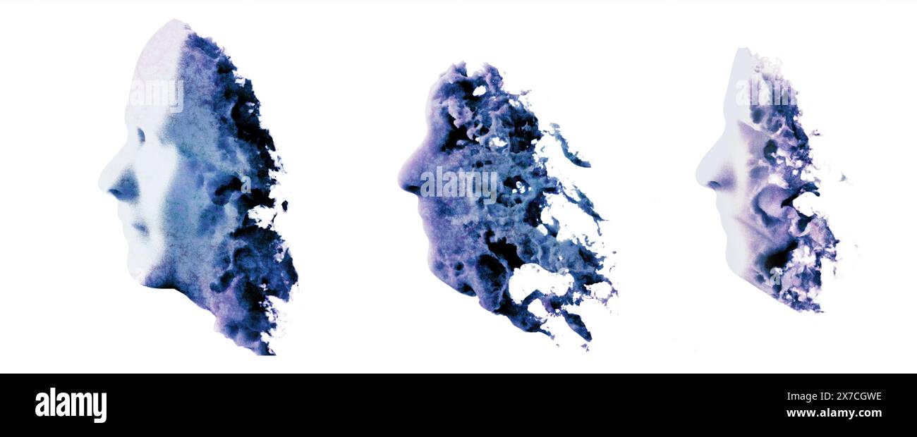 Face seen from the side. Degenerative disease. Brain degenerative ...