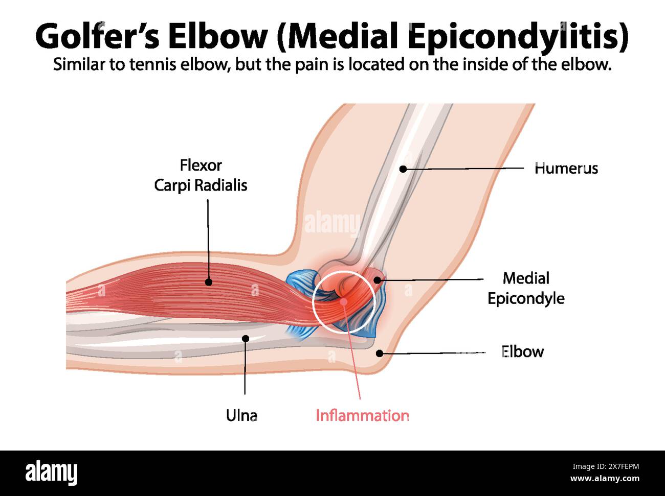 Detailed diagram of medial epicondylitis in the elbow Stock Vector Image & Art - Alamy
