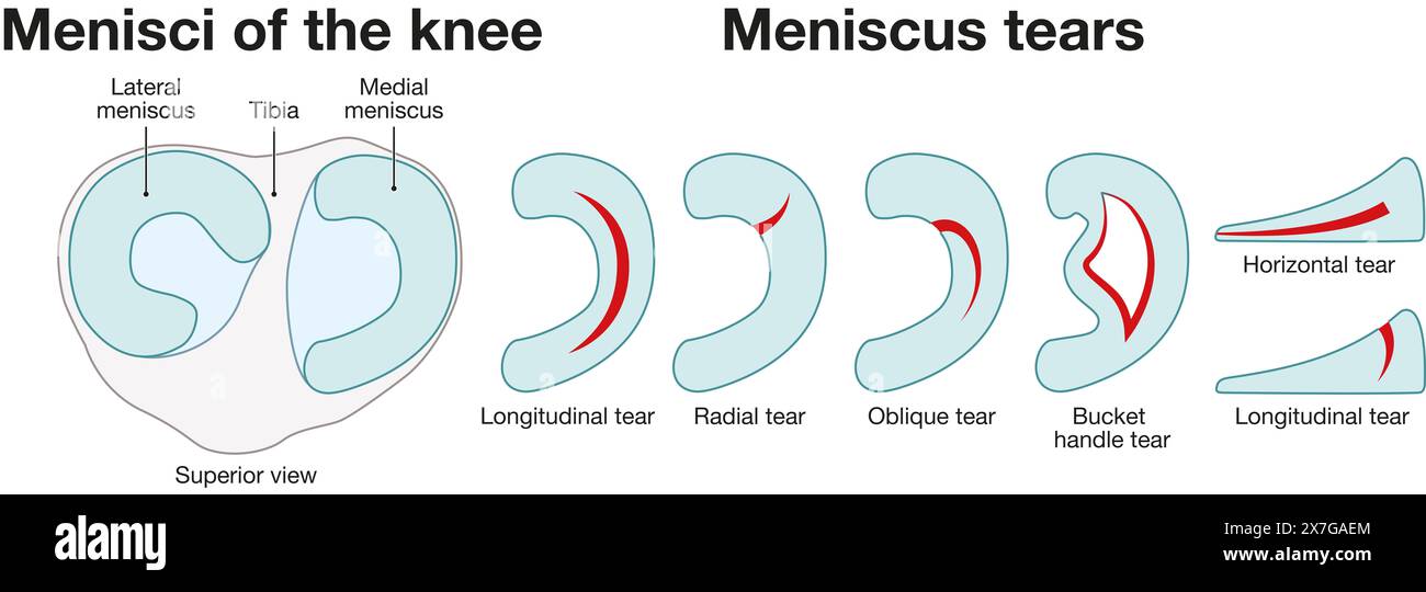 Meniscus tears are knee injuries causing pain, swelling, and limited ...