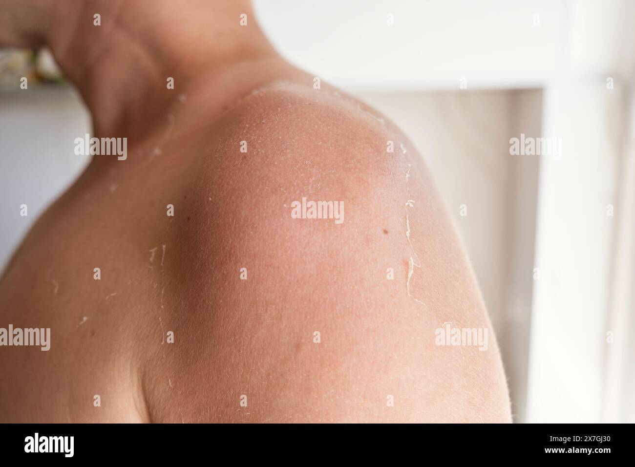 Sunburn on the skin. Exfoliation of the skin after sunburn. Man with ...
