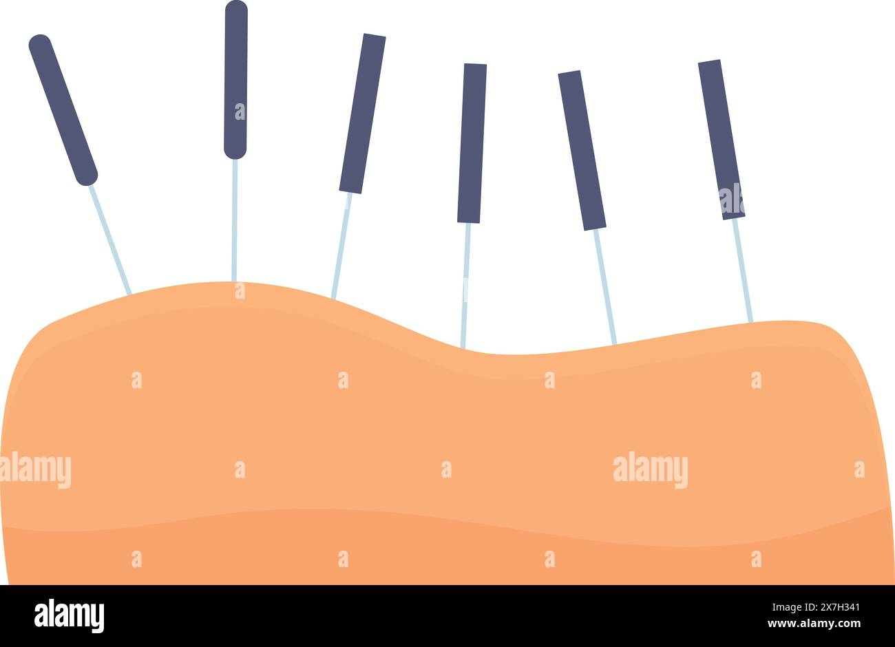 Illustration of acupuncture needles placement for therapeutic ...