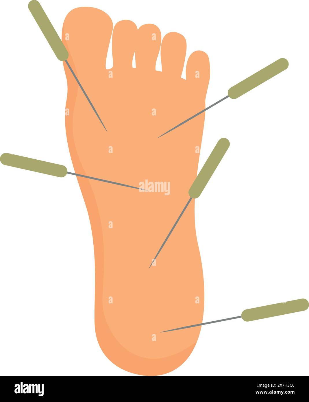 Vector illustration of acupuncture therapy for foot pain relief and ...