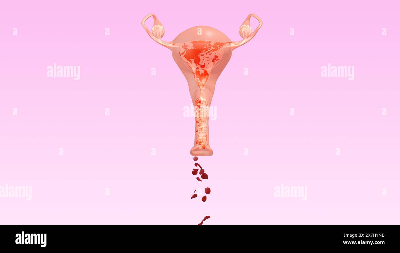 Menorrhagia also known as heavy menstrual bleeding or hematemesis Stock ...