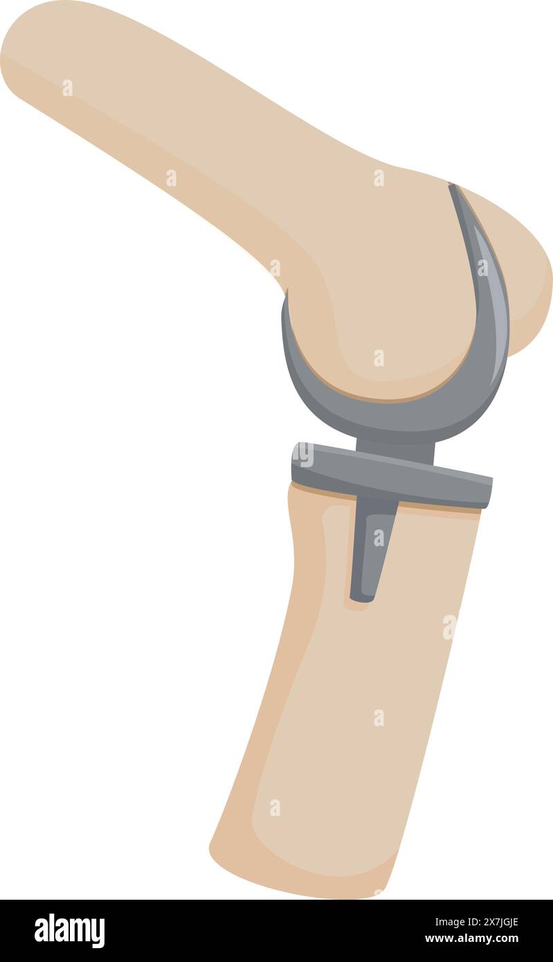Vector illustration of a modern prosthetic knee joint, isolated on a ...